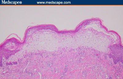 Multiple Tense Bullae on the Trunk and Extremities of an Elderly Man