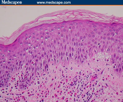 Multiple Tense Bullae on the Trunk and Extremities of an Elderly Man