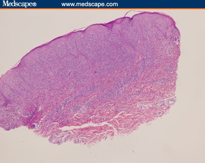 Scattered Yellow-Brown Papules in a Male Infant