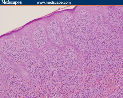 Scattered Yellow-Brown Papules in a Male Infant