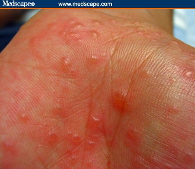 Papules and Bullae on the Palms and Soles of a 34-Year-Old Woman