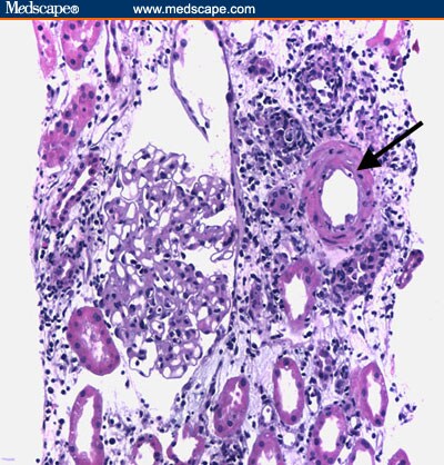 C4d Detection for Diagnosis of Humoral Rejection