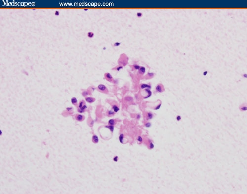 2 Cases: Headache, Nausea, Vomiting; Pulmonary Nodules