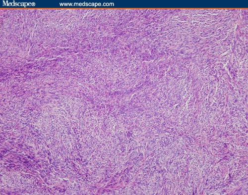 Renal Mass; Orbital Lesion