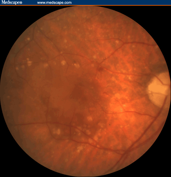 Treatment Strategies for AMD: A Review of 3 Clinical Case Presentations