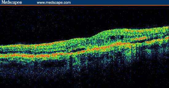 Treatment Strategies for AMD: A Review of 3 Clinical Case Presentations