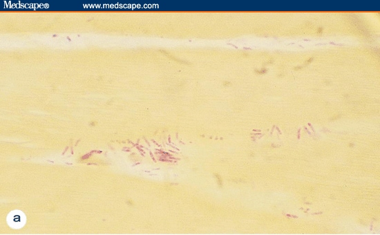 A Case-Based Approach to Treating Serious Skin Infections