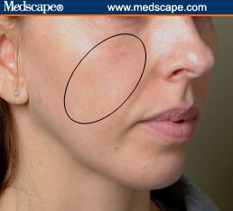 Dermal Fillers in Cheek Rejuvenation