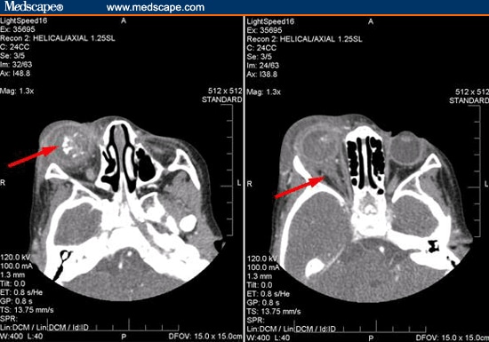 A 2-Year-Old Boy With Redness, Discharge, and Swelling of his Right Eye