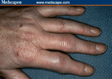 Rheumatoid Arthritis in Primary Care