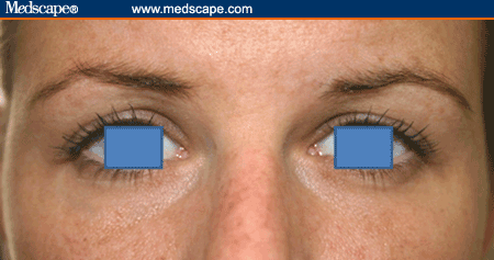 Techniques for Minimally Invasive Rejuvenation of the Periorbital Region