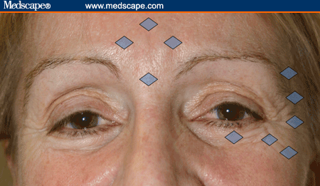 Techniques for Minimally Invasive Rejuvenation of the Periorbital Region