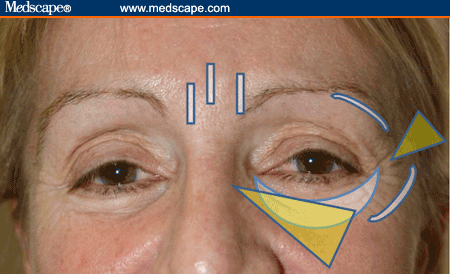 Techniques for Minimally Invasive Rejuvenation of the Periorbital Region