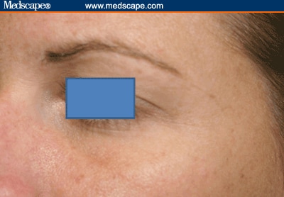 Techniques for Minimally Invasive Rejuvenation of the Periorbital Region