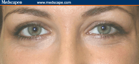 Techniques for Minimally Invasive Rejuvenation of the Periorbital Region