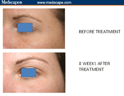 Techniques for Minimally Invasive Rejuvenation of the Periorbital Region