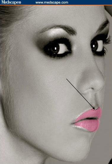 Lip Augmentation and Rejuvenation Techniques