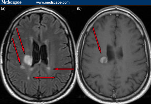 A Case-Based Approach to Optimizing the Management of Multiple Sclerosis