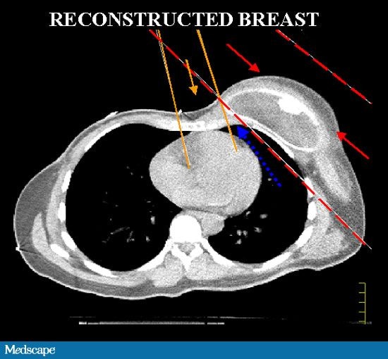Integrating Radiation Therapy and Breast Reconstruction: Which Comes First?