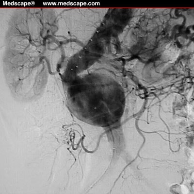 Abdominal Aortic Aneurysm: Screening for a Silent Threat