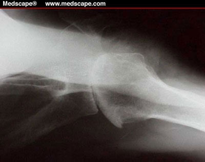 Shoulder Replacement