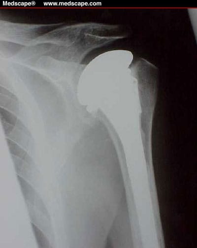 Shoulder Replacement