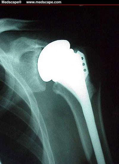 Shoulder Replacement
