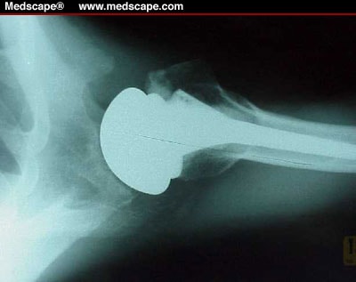 Shoulder Replacement