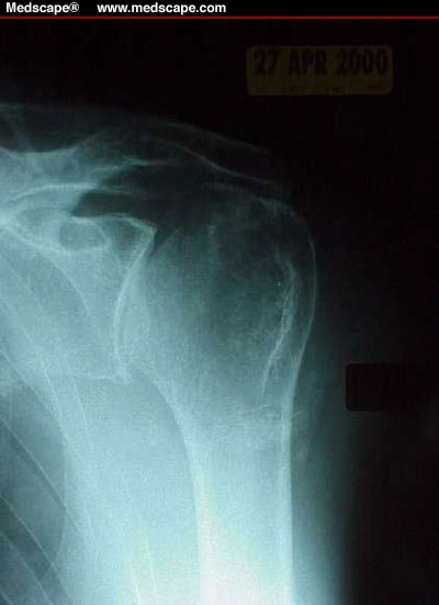 Shoulder Replacement