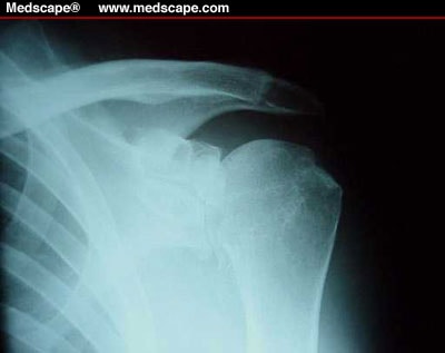 Shoulder Replacement