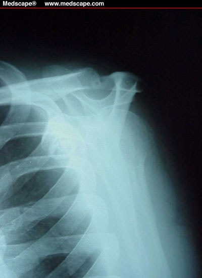 Shoulder Replacement