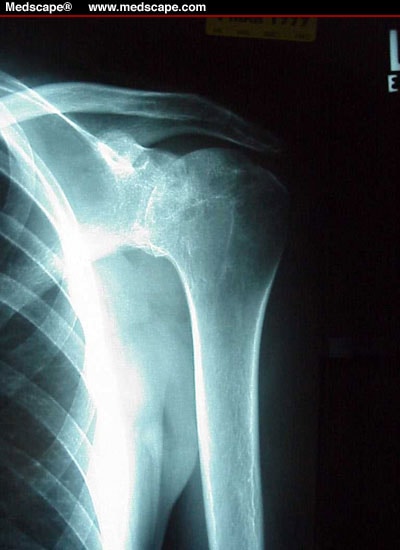 Shoulder Replacement