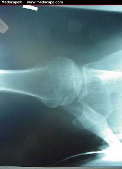 Shoulder Replacement