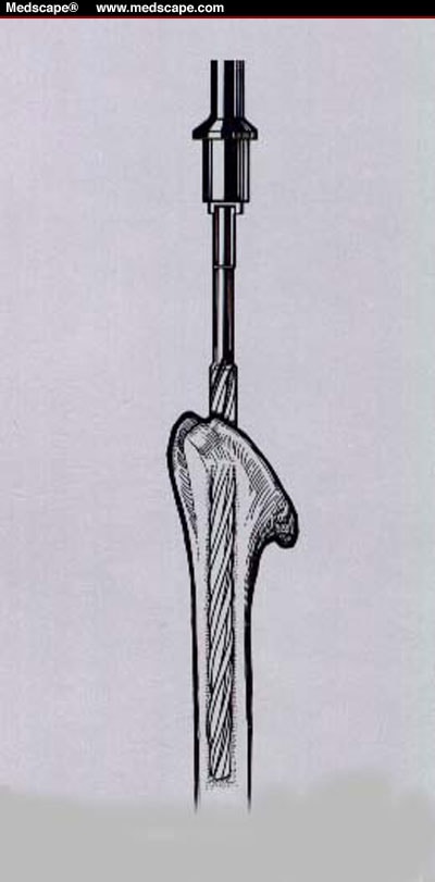 Shoulder Replacement