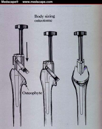 Shoulder Replacement