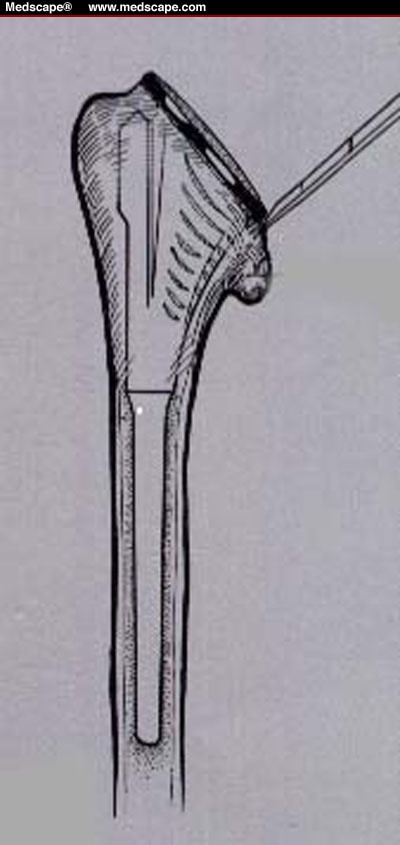 Shoulder Replacement