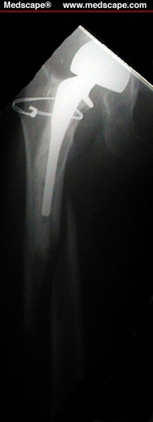 Periprosthetic Fractures of the Femur