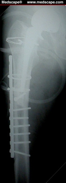 Periprosthetic Fractures of the Femur