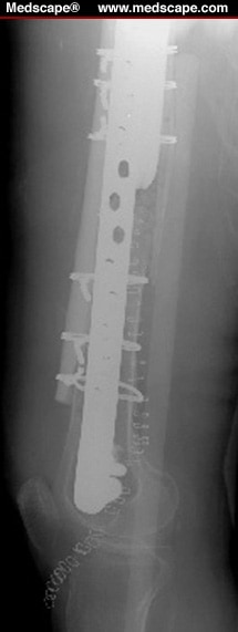 Periprosthetic Fractures of the Femur