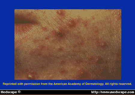 Primary Care Dermatology Roundtable: Common Dermatologic Conditions...