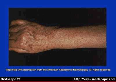 Primary Care Dermatology Roundtable: Common Dermatologic Conditions...