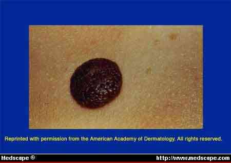 Primary Care Dermatology Roundtable: Common Dermatologic Conditions...