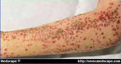 Primary Care Dermatology Roundtable: Common Dermatologic Conditions...
