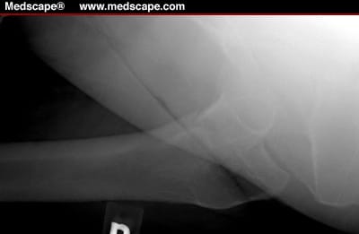 Femoral Neck Fractures