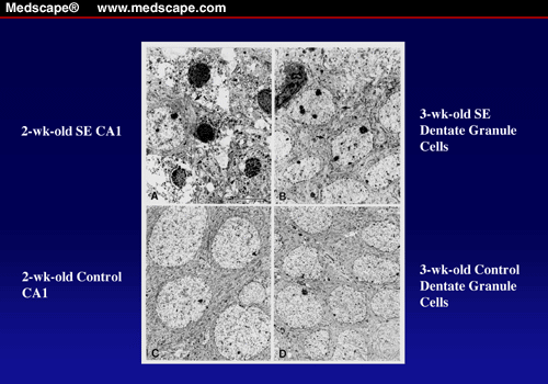 The Progressive Nature of Epilepsy as a Consideration in Patient...