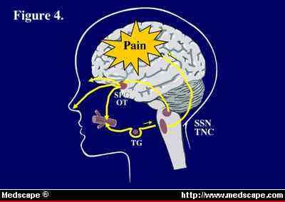 New Treatment Options in Migraine