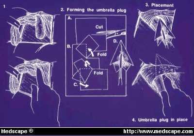 Inguinal Hernia: Anatomy and Management