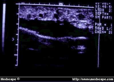 Inguinal Hernia: Anatomy and Management