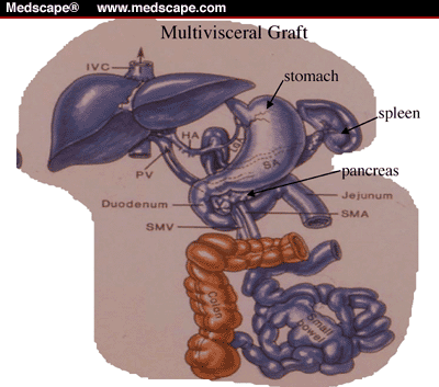 Intestinal Transplantation