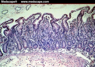 Intestinal Transplantation